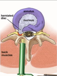 Microdiscectomy vs. Laser Endoscopic Spine Surgery for Herniated Discs ...